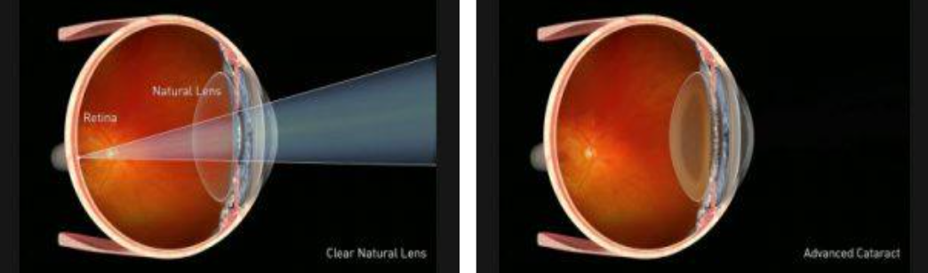 Cataracts in Clarkston, Waterford & Oakland County, MI | Oakland Eye Care